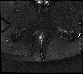「科普」肛瘘的磁共振（MRI）诊断与评估-健康科普-漯河市中心医院