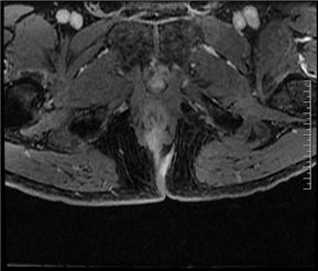 「科普」肛瘘的磁共振（MRI）诊断与评估-健康科普-漯河市中心医院