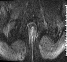 「科普」肛瘘的磁共振（MRI）诊断与评估-健康科普-漯河市中心医院
