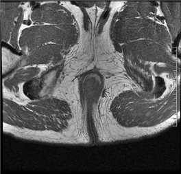 「科普」肛瘘的磁共振（MRI）诊断与评估-健康科普-漯河市中心医院